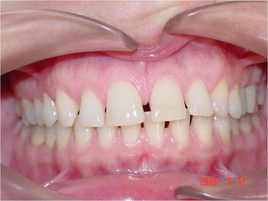 Má oclusão - Classe I :: APOTAS