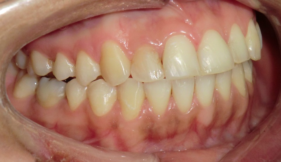 Má oclusão - Classe III :: APOTAS